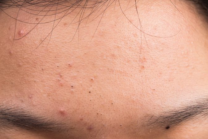 What is a Blackhead and What Cause Blackheads and How to Get Rid ...